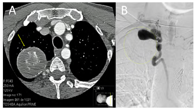Giant aneurysm originating from the costocervical trunk in a patient ...