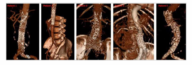 ChEVAR technique for emergent aneurysm repair - a retrospective case series