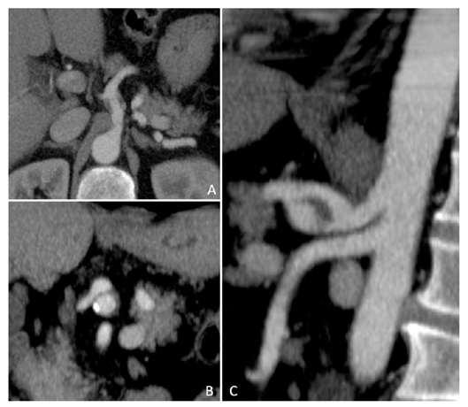 Spontaneous isolated celiac and splenic artery dissection