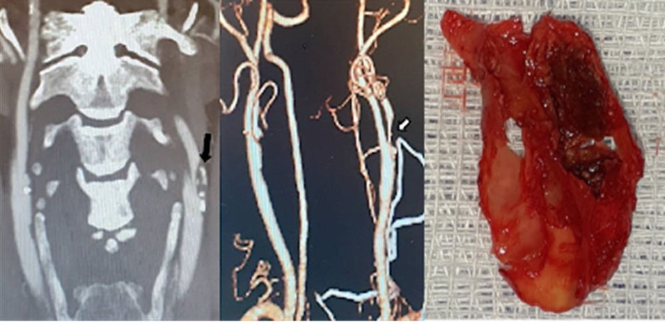 Correlation of ulcerated plaque image with intraoperative findings