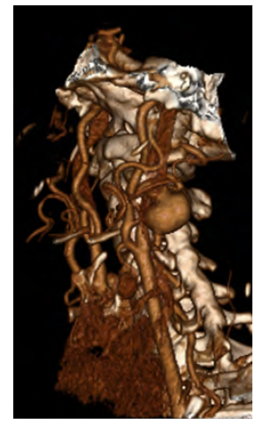 Extra-cranial internal carotid aneurysm repair - the importance of ...