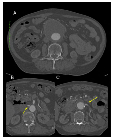 Fenestrated Physician-Modified Endografts (PMEGs) - a viable option for ...