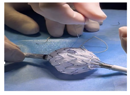 Fenestrated Physician-Modified Endografts (PMEGs) - a viable option for ...