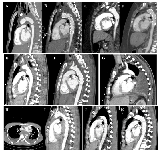 Blunt traumatic injuries of thoracic aorta, a retrospective study