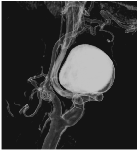 Surgical repair of cervical internal carotid artery aneurysm in a ...