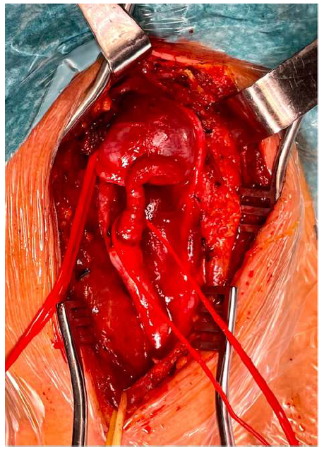 Surgical repair of cervical internal carotid artery aneurysm in a ...