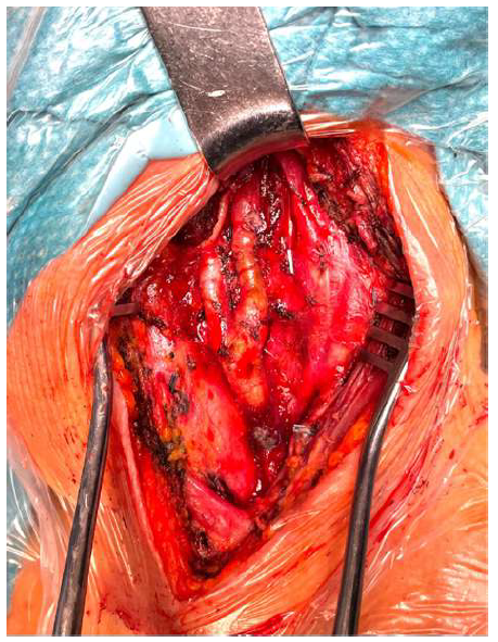 Surgical repair of cervical internal carotid artery aneurysm in a ...