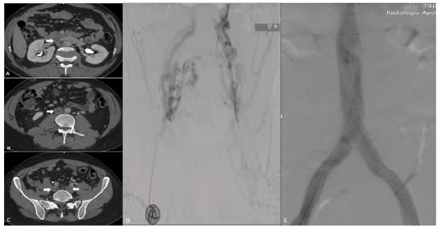 Conquering complex anatomy: EVAR success in a zig-zagging aortic aneurysm