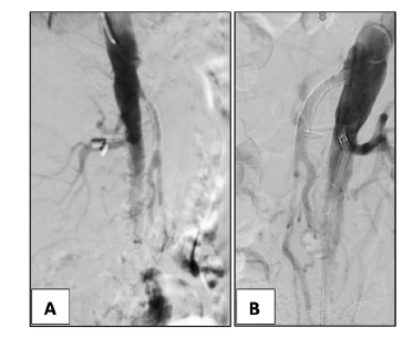 Comparing outcomes after open and endovascular chronic mesenteric ...