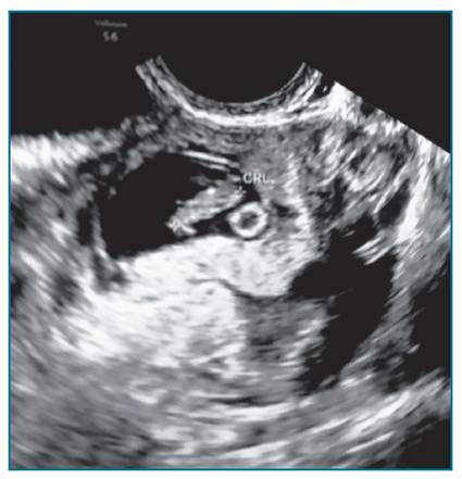 Left interstitial ectopic pregnancy in a woman with ipsilateral adnexectomy