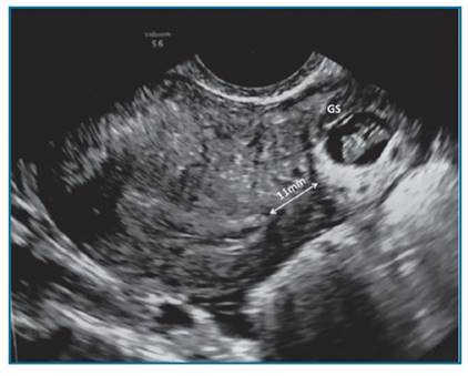 Left interstitial ectopic pregnancy in a woman with ipsilateral adnexectomy