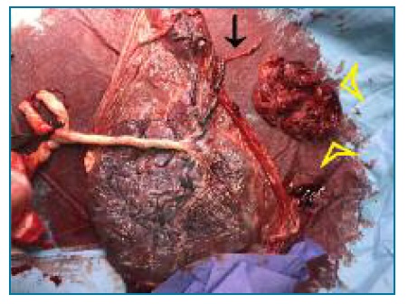 The importance of postpartum placental examination