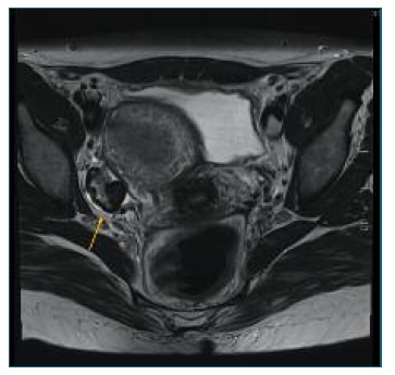 The “Black Garland” sign in ovarian fibromatosis