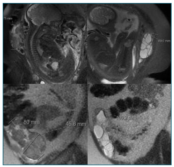 Diagnosis And Management Of Hyperreactio Luteinalis A Rare Condition In Pregnancy