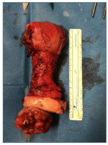 Cervical elongation caused by cervical fibroid mimicking uterine prolapse