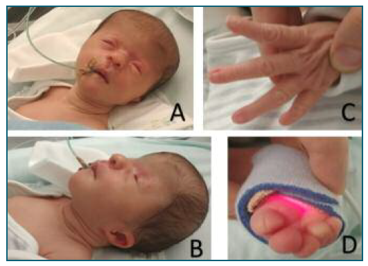 Congenital ichthyosiform erythroderma in pregnancy: a case report of a ...