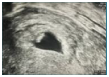 Treatment of a giant uterine fibroid during pregnancy: a case report