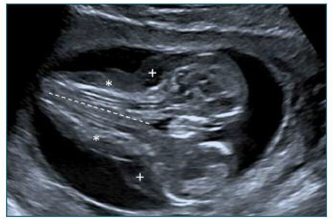 Dicephalus-Parapagus twins: a rare case