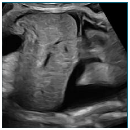 Fetal pleural effusion - a rare case of shunt migration