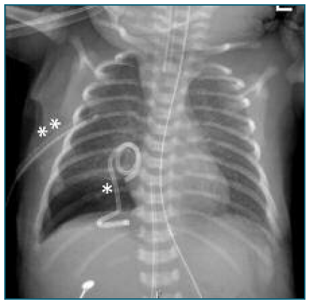 Fetal pleural effusion - a rare case of shunt migration