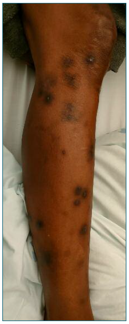 Acquired perforating dermatosis - a case beyond Obstetric
