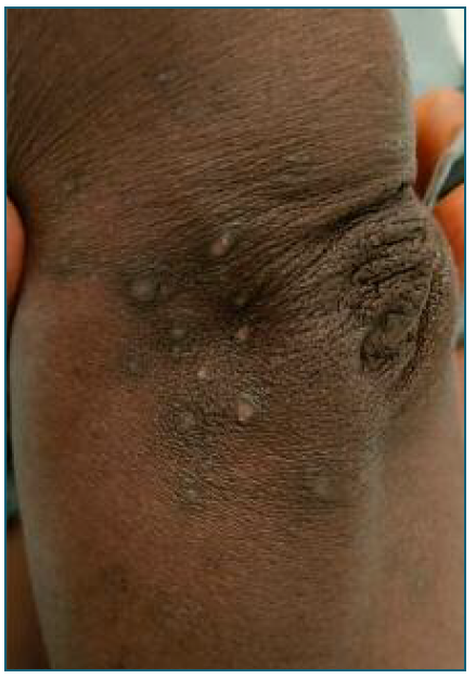 Acquired perforating dermatosis - a case beyond Obstetric