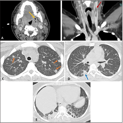 Lemierre Syndrome: An Overlooked Diagnosis in Otherwise Healthy Patients