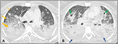 Lemierre Syndrome: An Overlooked Diagnosis in Otherwise Healthy Patients