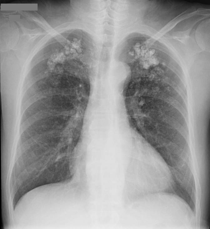 Metastatic Pulmonary Calcification: A Complication of Chronic Renal Disease