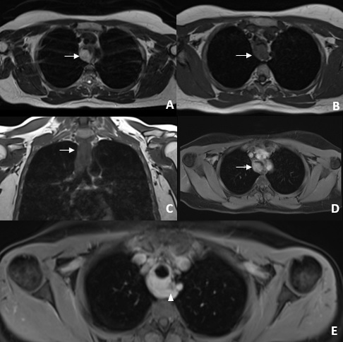 Primary Adenoid Cystic Carcinoma: An Uncommon Cause of Tracheal Obstruction