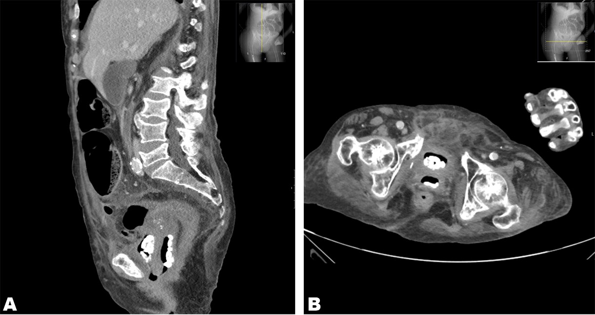Vaginal Lithiasis - A Rare Case