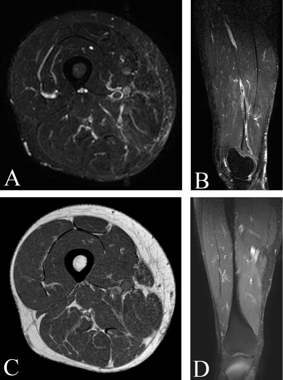 Radiation Recall Myositis