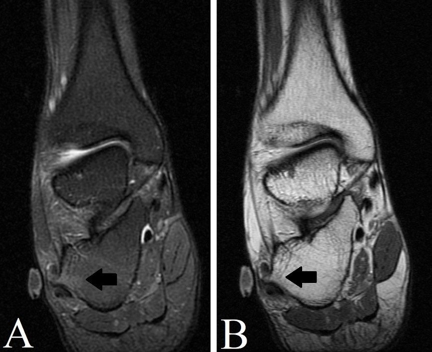 Tenosynovitis of the Peroneal Tendons Due to Hypertrophy of the ...