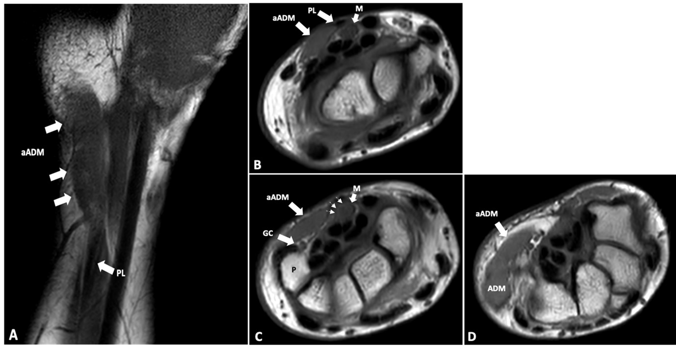 Accessory Abductor Digiti Minimi: A Rare Cause or just an Incidental ...