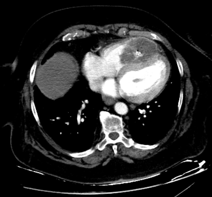 Extraskeletal Mesenchymal Chondrosarcoma Heart Metastasis: A Rare Entity