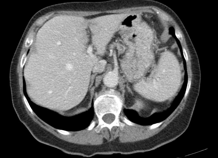 Fish Bone Perforation: A Rare Cause of Liver Abscess