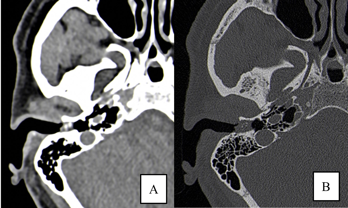 Cholesteatoma of the External Auditory Canal: A Common Entity at a Rare ...