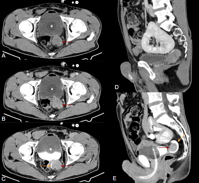 Carcinoma Urotelial com Origem em Divertículo de Hutch