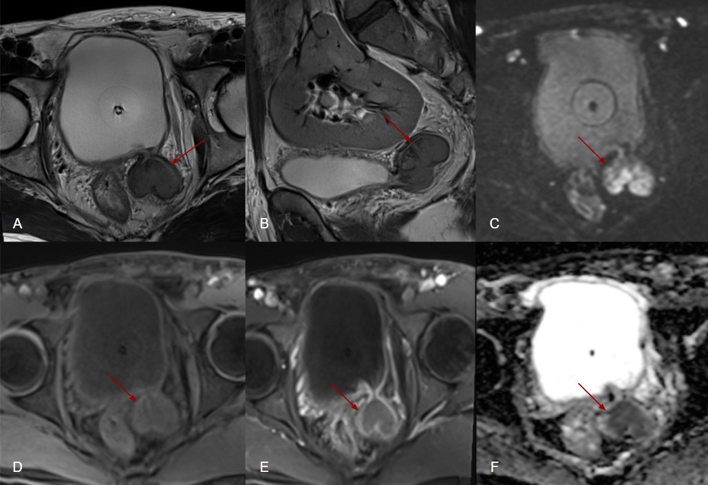Carcinoma Urotelial com Origem em Divertículo de Hutch