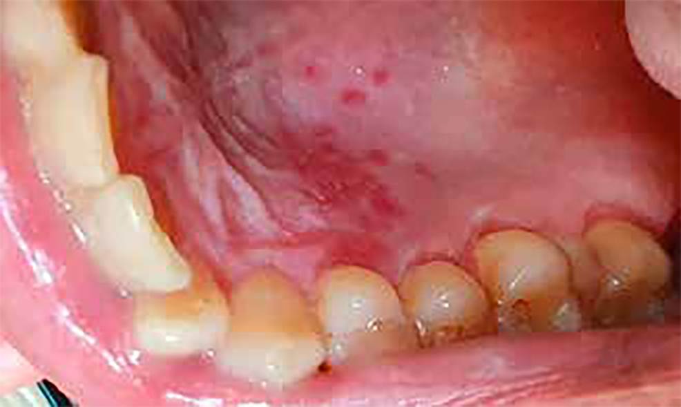 Oral Cavity Herpes Zoster: A Rare Presentation of Shingles