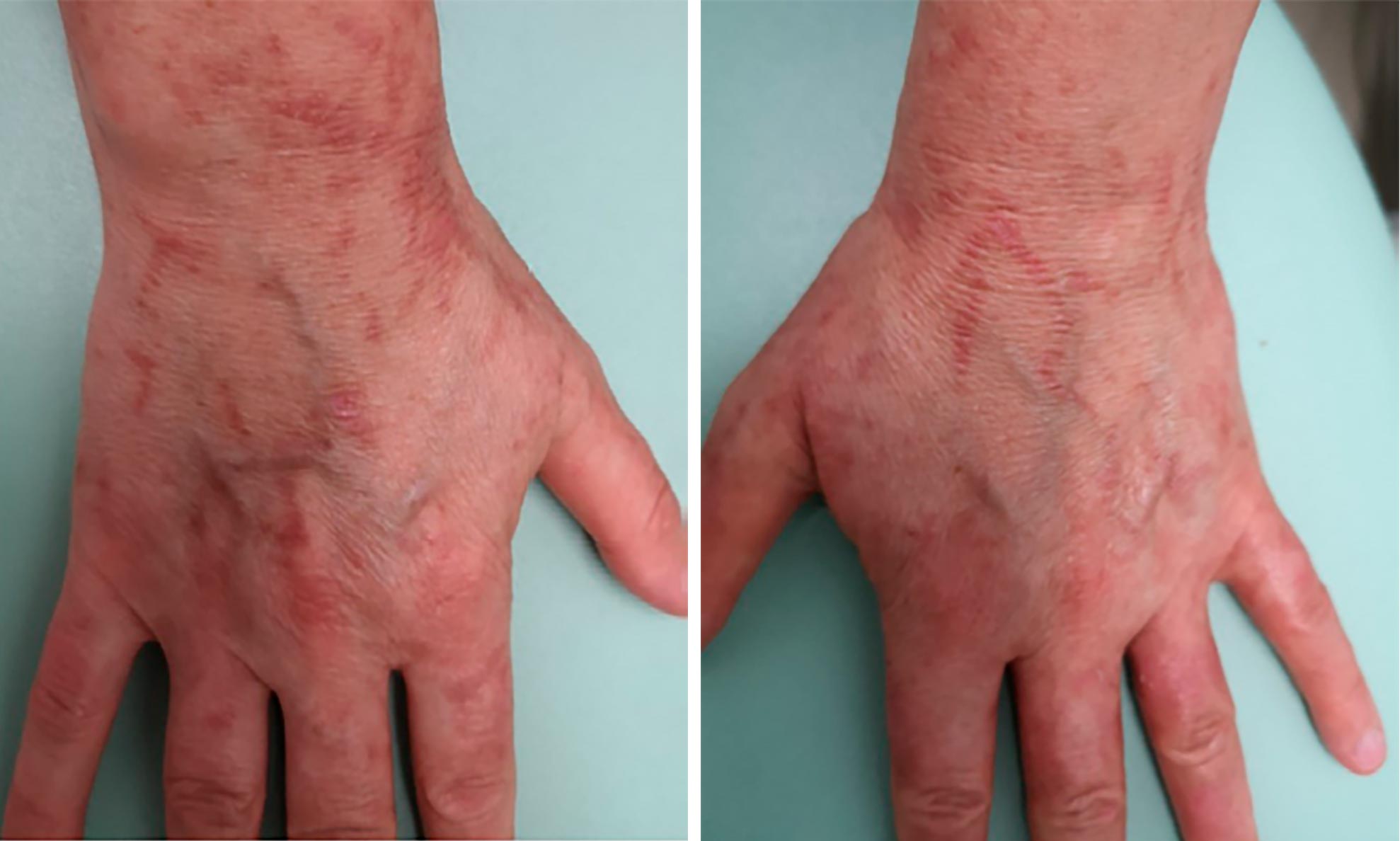 Plantas que Marcam: Fitofotodermatose