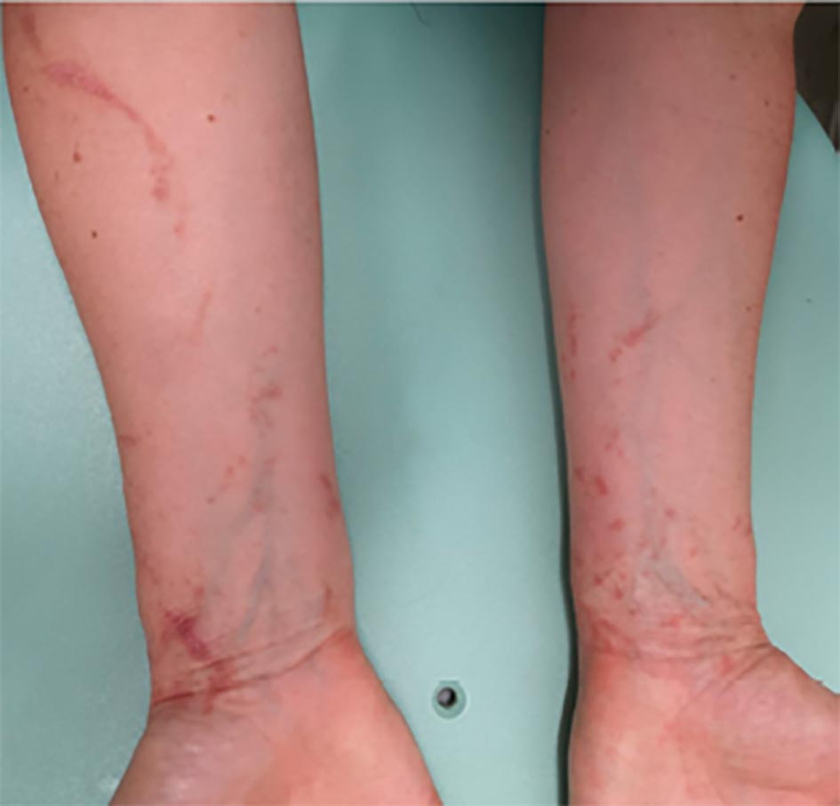 Plantas que Marcam: Fitofotodermatose