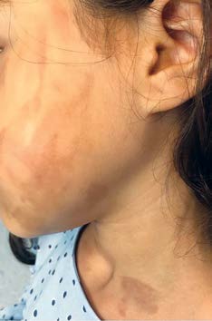A Case of Lime-Induced Phytophotodermatitis