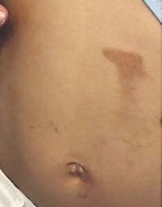 A Case of Lime-Induced Phytophotodermatitis