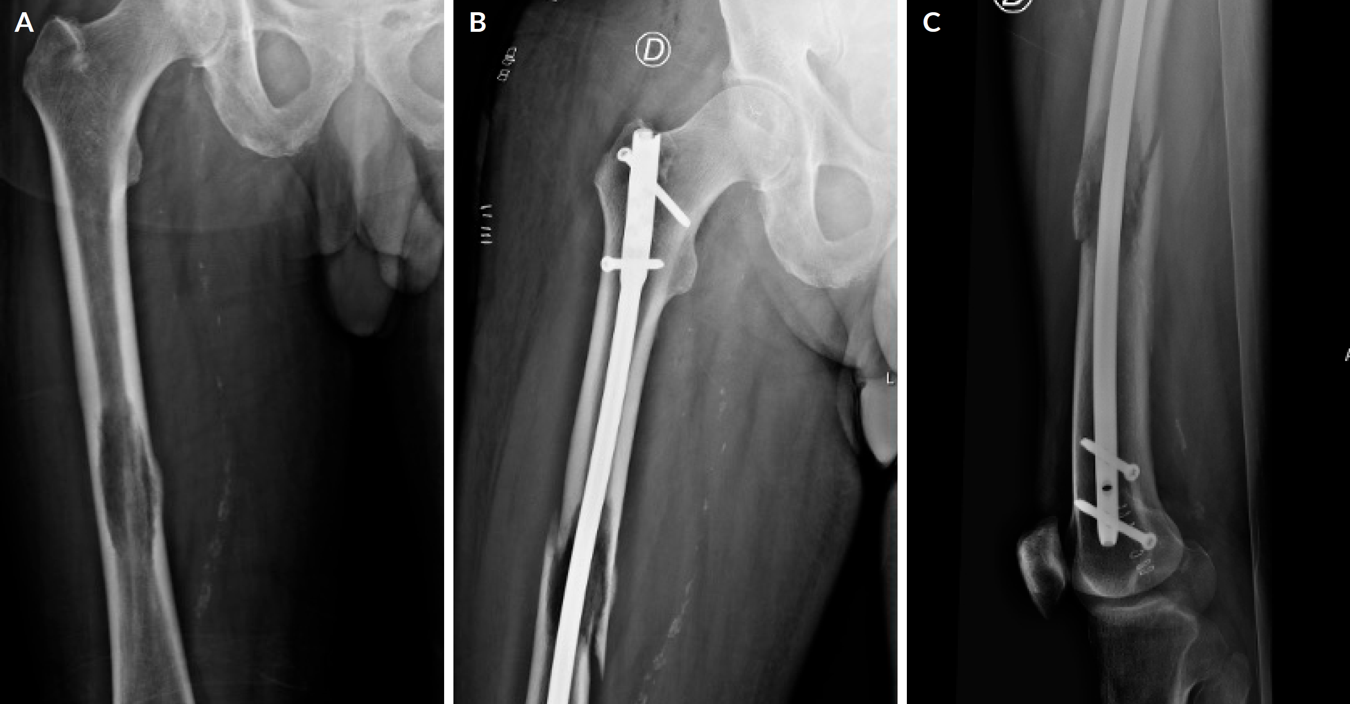 Preventing Proximal Femur Pathologic Fractures Improves Outcomes in ...