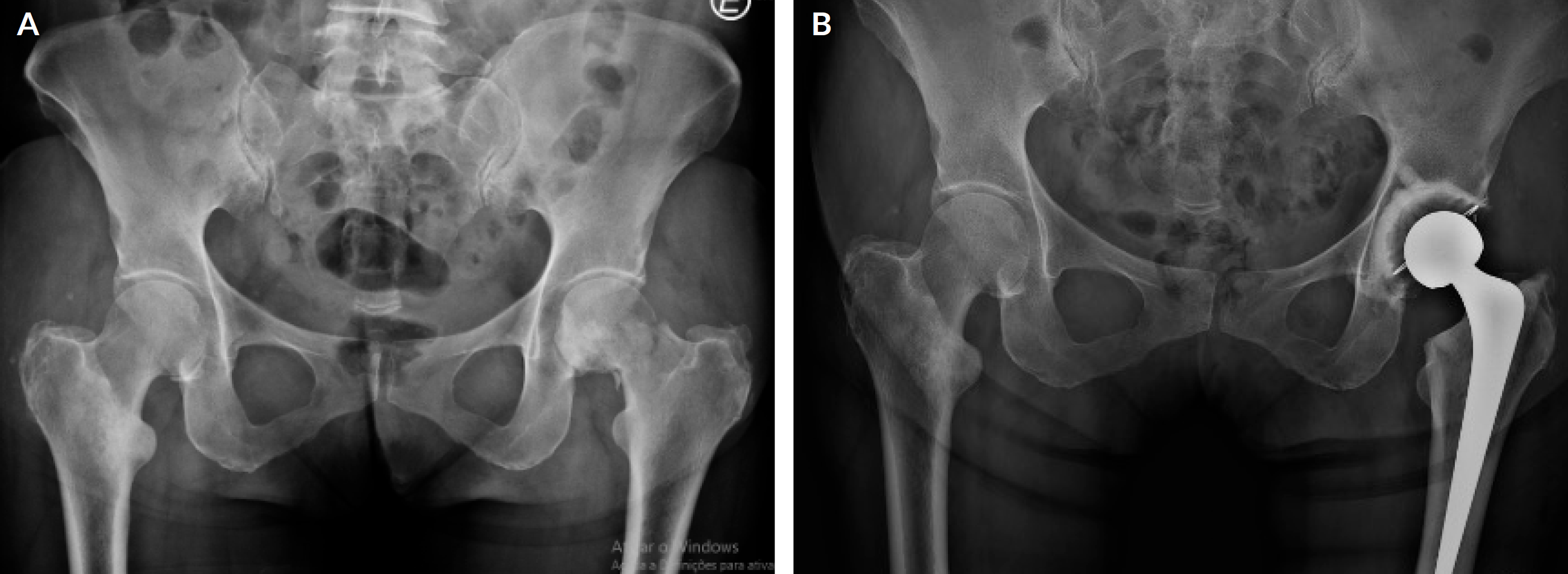 Preventing Proximal Femur Pathologic Fractures Improves Outcomes in ...