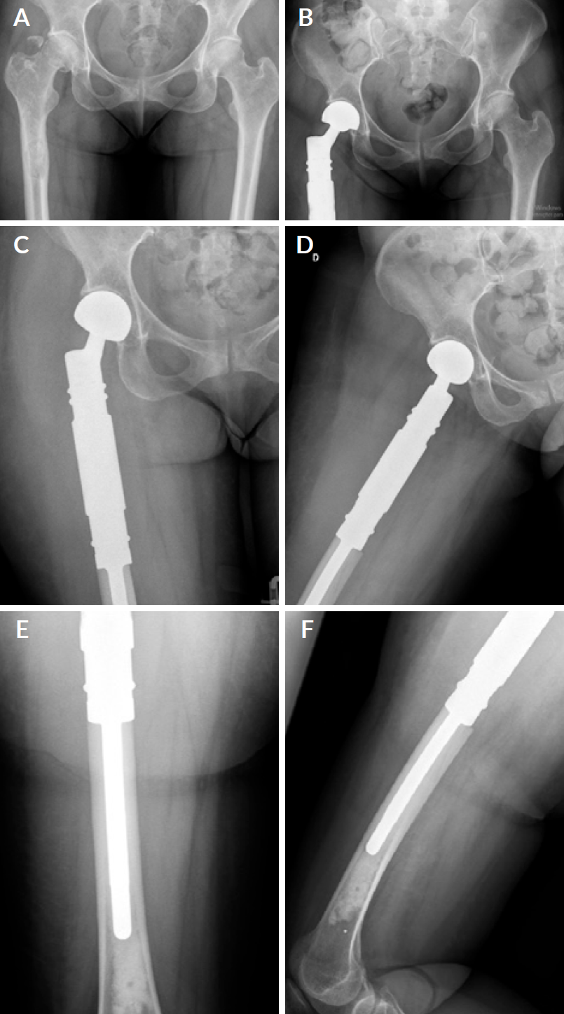 Preventing Proximal Femur Pathologic Fractures Improves Outcomes in ...