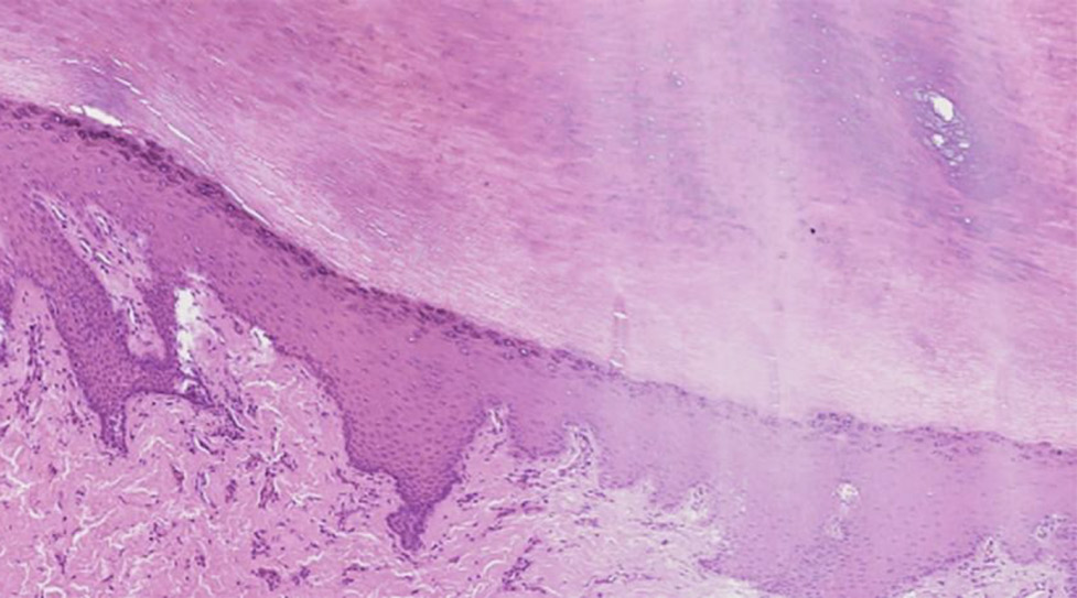 Punctate Palmoplantar Keratoderma