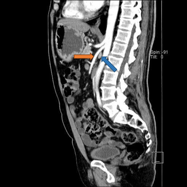Síndrome da Artéria Mesentérica Superior: Uma Causa Rara de Oclusão ...