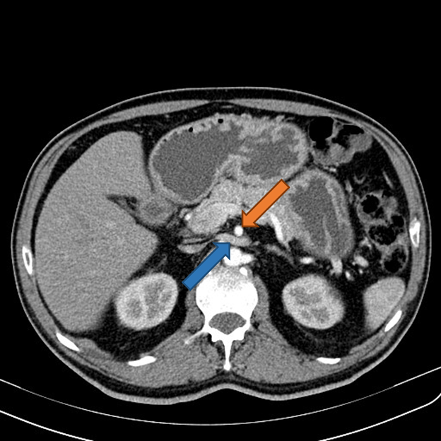 Síndrome da Artéria Mesentérica Superior: Uma Causa Rara de Oclusão ...